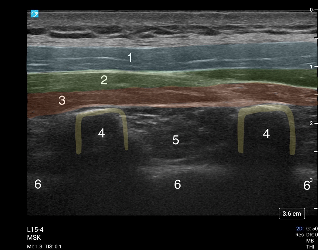 ESP Block Anatomy Image | Sonosite Institute for Point-of-Care Ultrasound
